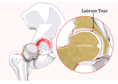 Hip Labral Surgery | Hip Surgeon | Santa Barbara, Santa Maria, Ventura CA